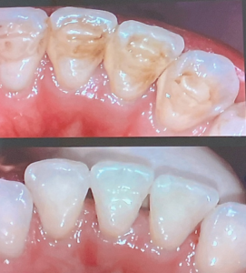 PMTC(Cleaning)｜麹町の歯医者｜MYデンタルオフィス麹町